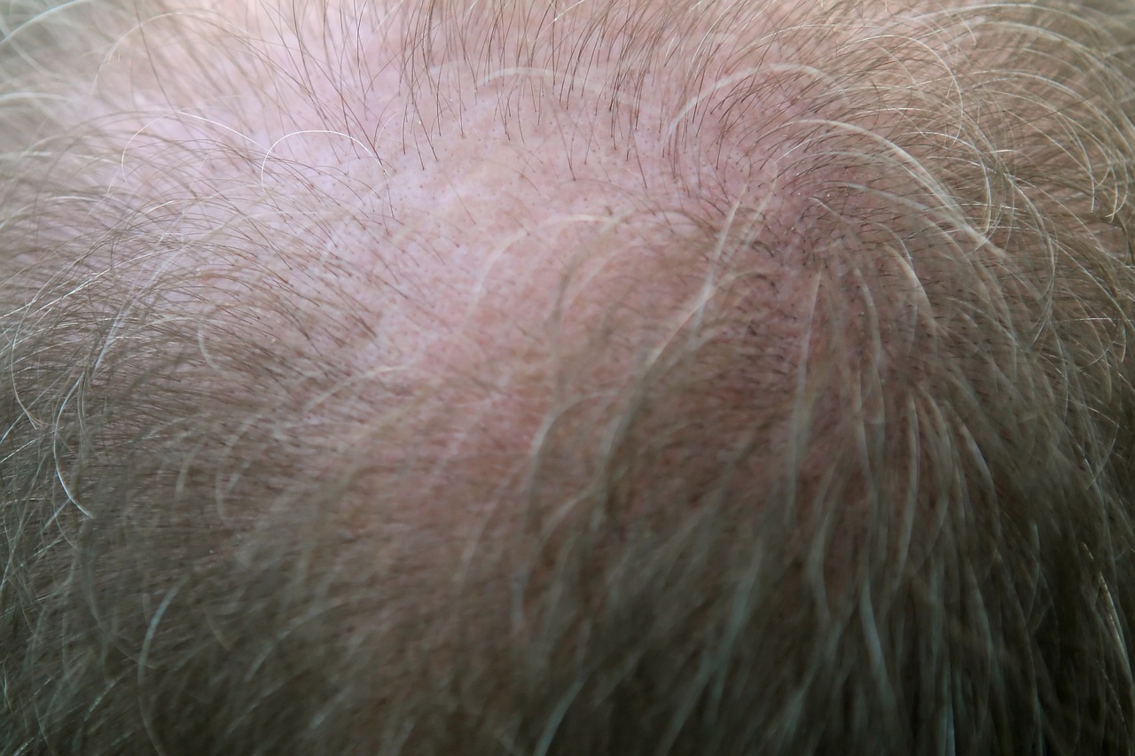 Four Warning Signs You’re Going Bald - Lanna World